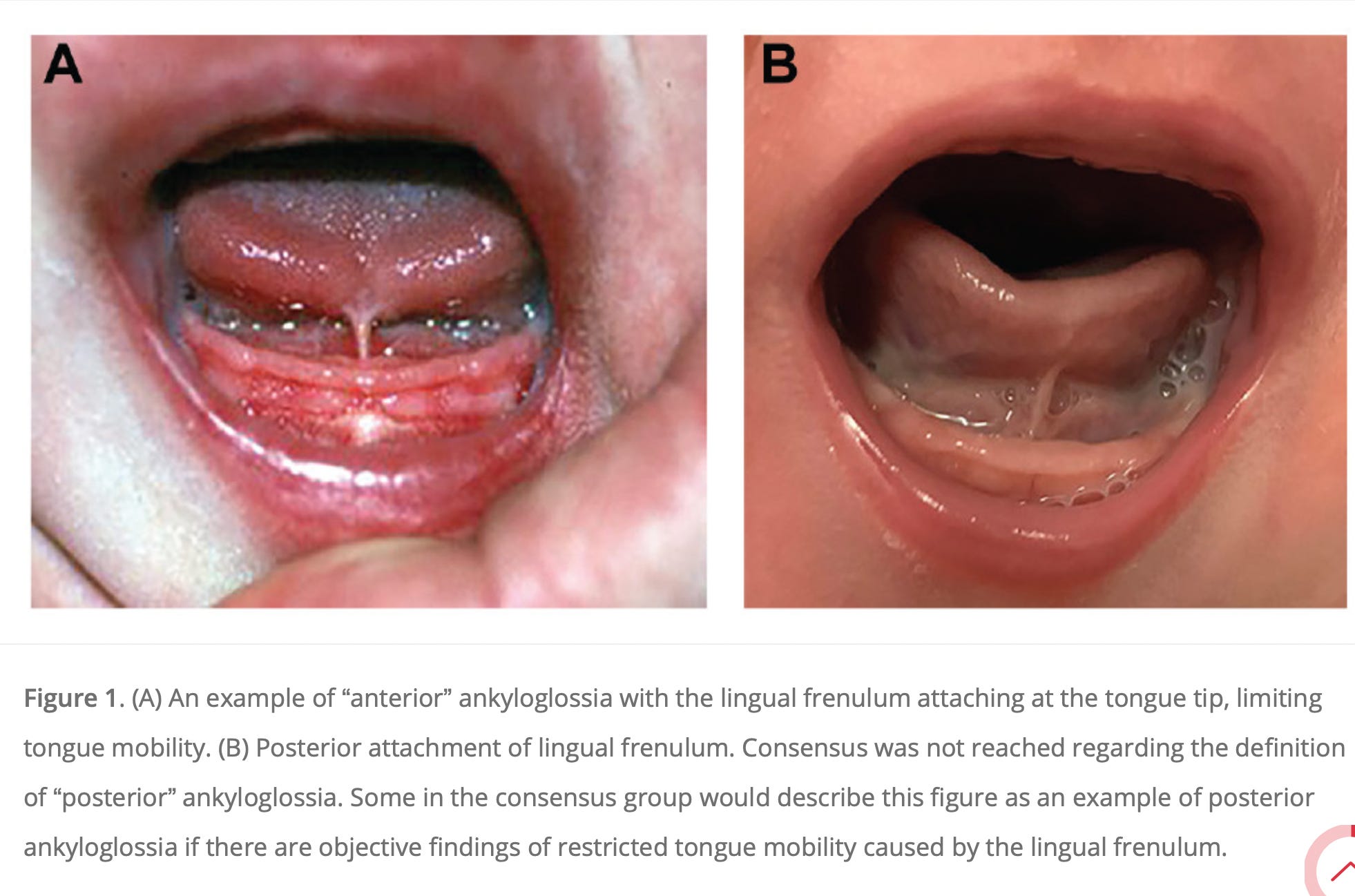 Defining The Anatomy Of The Neonatal Lingual Frenulum