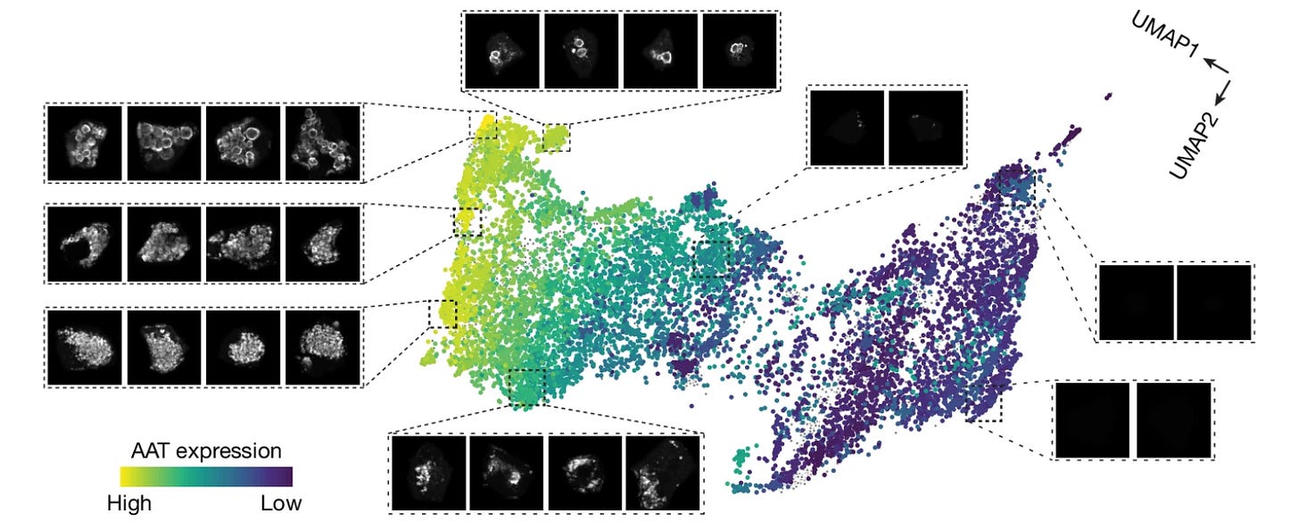 Deep Visual Proteomics and Its Promise for Understanding Diseases