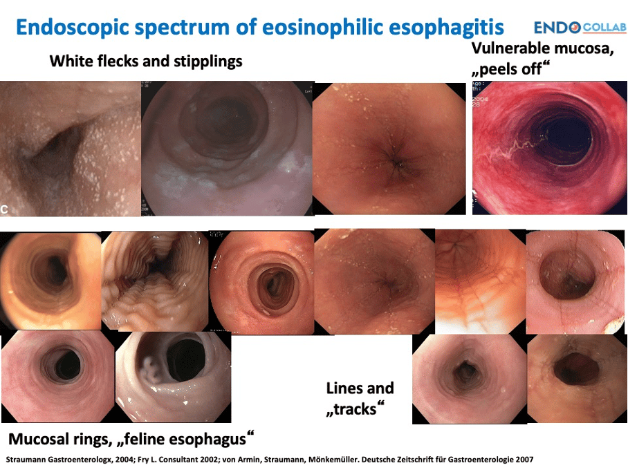 EREFS Score for Eosinophilic Esophagitis (EoE)