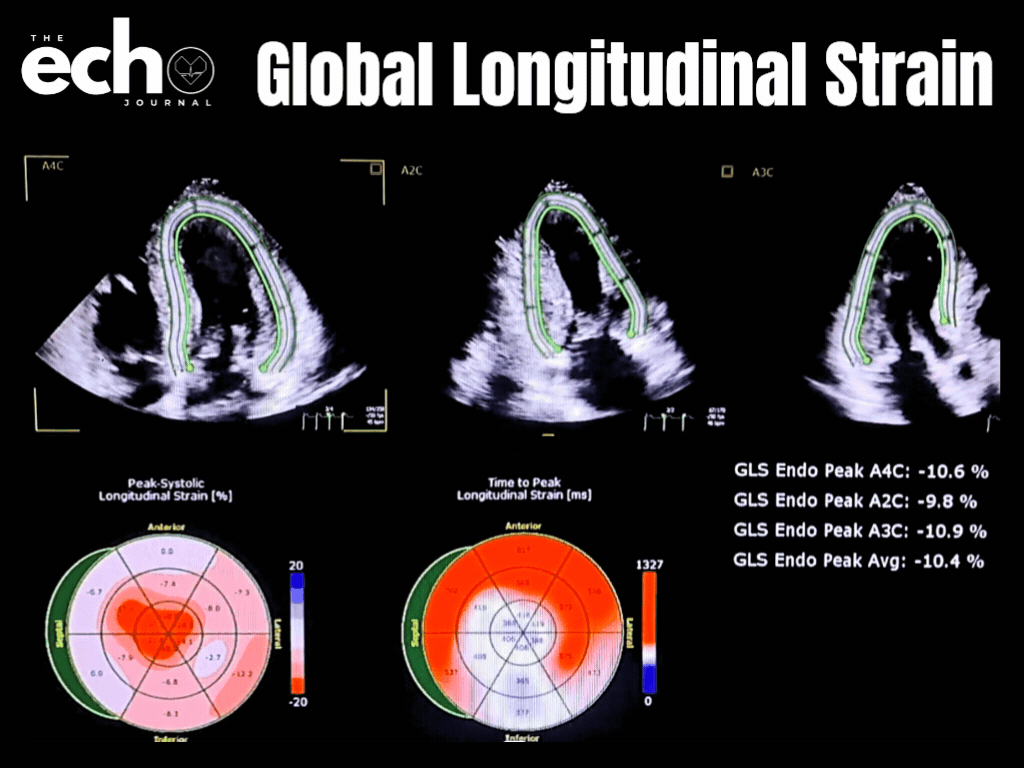 The Infiltrator: Recognizing Cardiac Amyloidosis on Echo