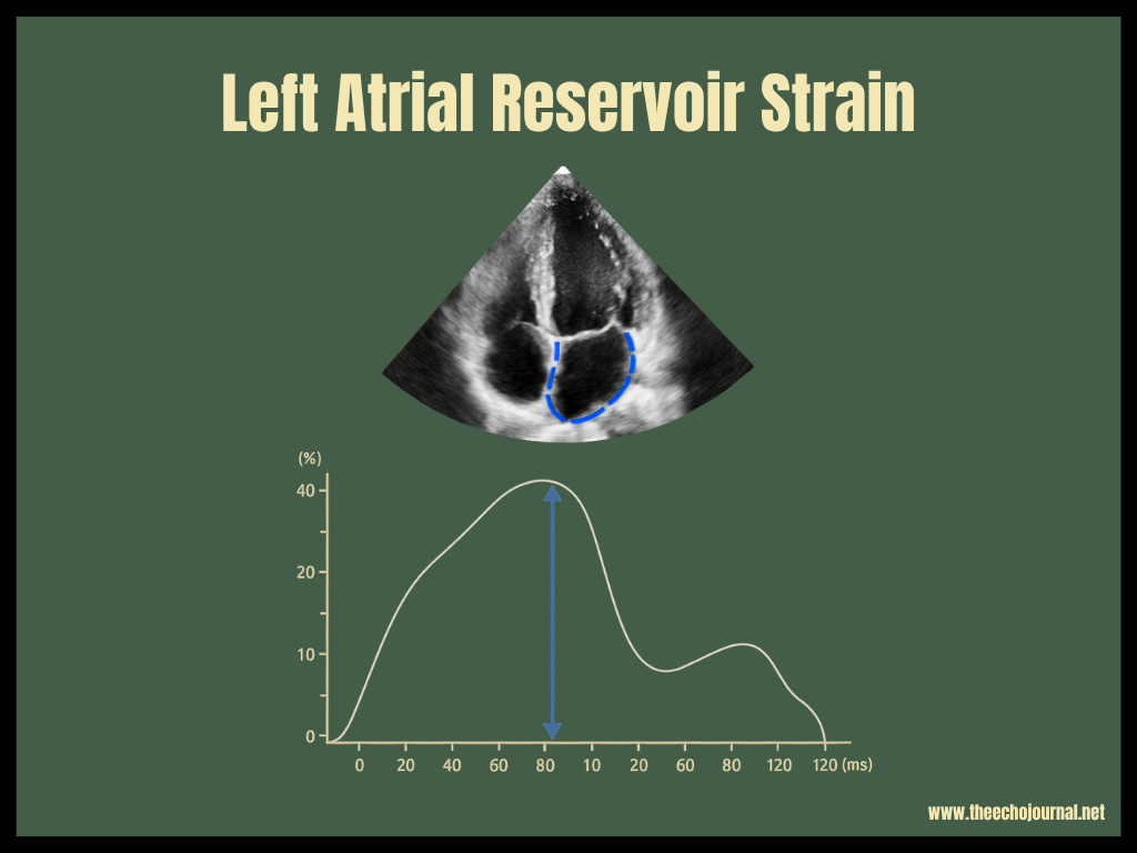 New Diastology Guidelines: Key Changes - by Aram K.