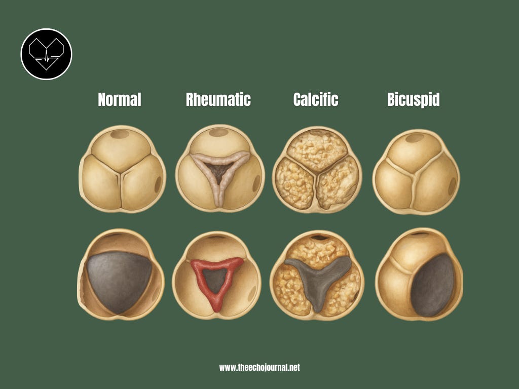 Aortic Stenosis: How to Calculate an AVA - by Aram K.