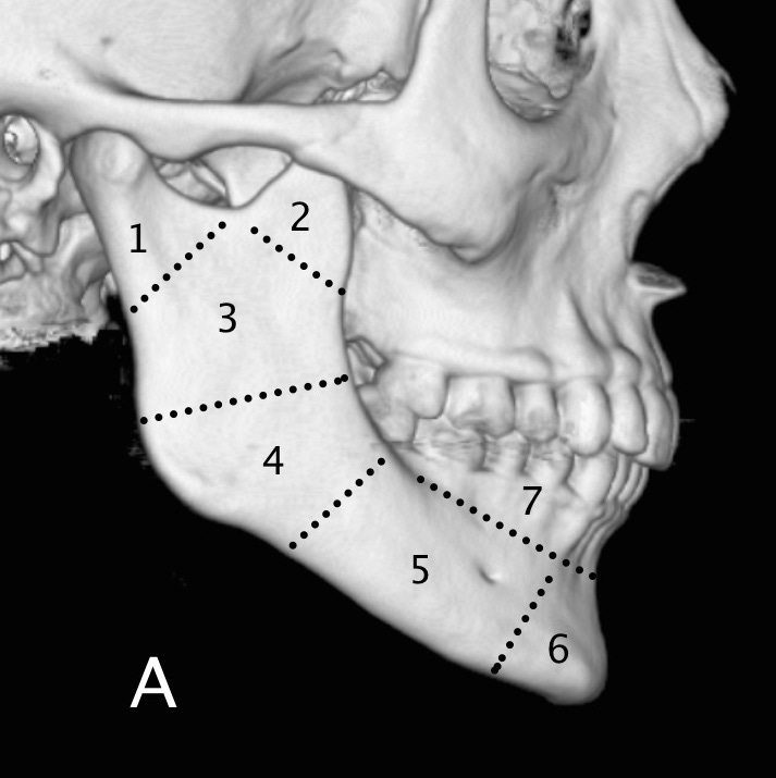 Mandible fracture - by Alexander Baxter - RadNotes