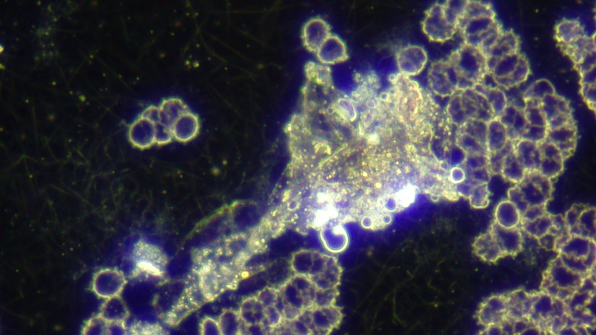 Blood under the Microscope before liposomal EDTA and Vitamin C