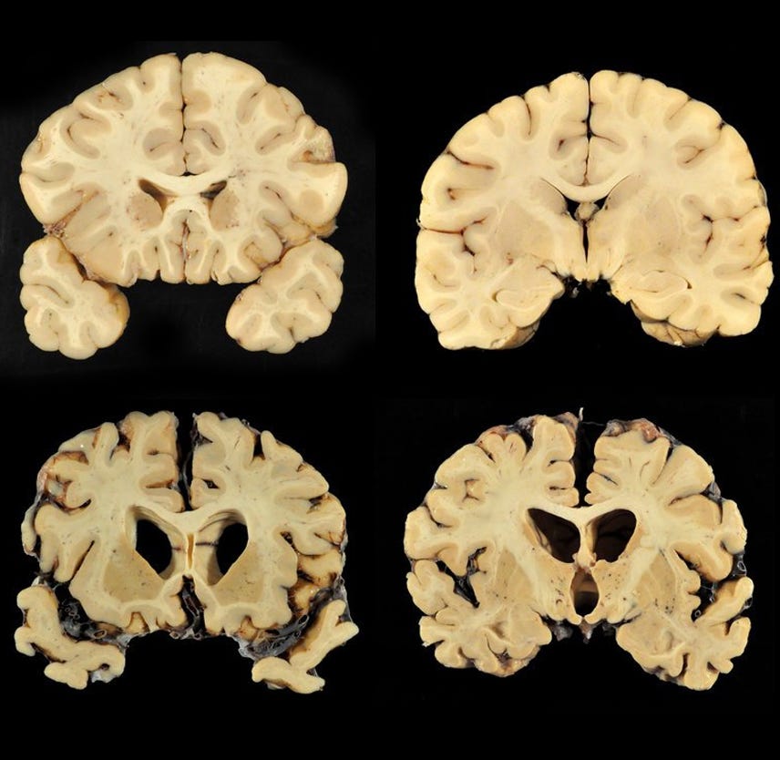 CTE in Athletes: A Study of Brain Injuries