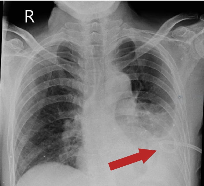 Chest Tubes & Pigtails: 5 Must-Know Tips for ICU Rotation