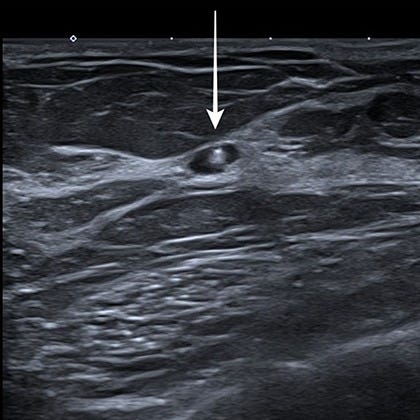 Titanium Markers in Breast Biopsies: Are They Safe and Do They Stay in ...
