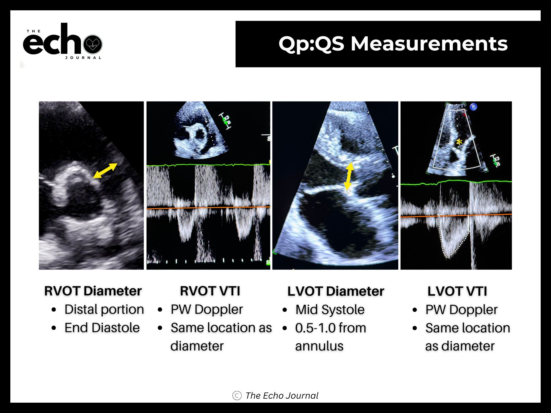 Qp:Qs Explained: Quantifying Hemodynamic Significance in Shunt Lesions