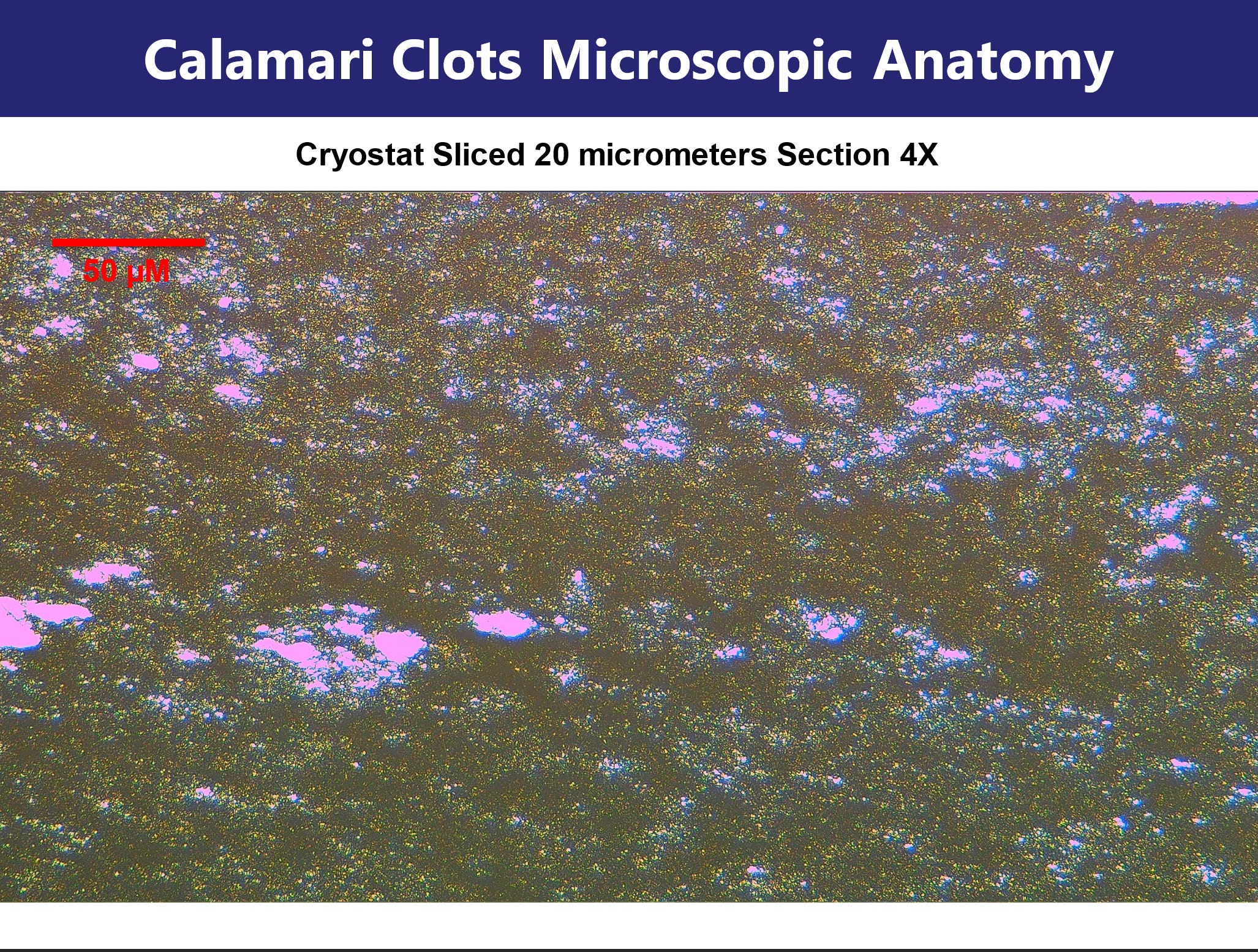 graviolateam finland: Anomalous Amyloid Microclots Found in 100% of the ...
