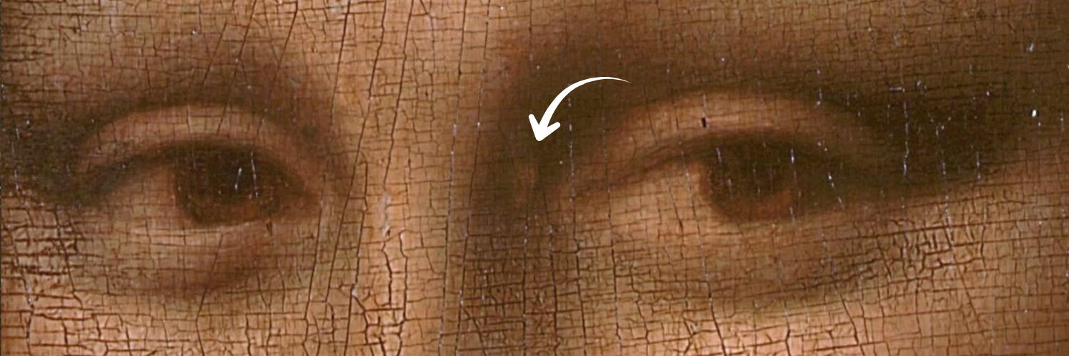 Was the Mona Lisa Sick? The Hidden Medical Secrets