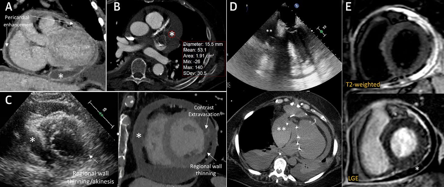 Manejo do Derrame Pericárdico