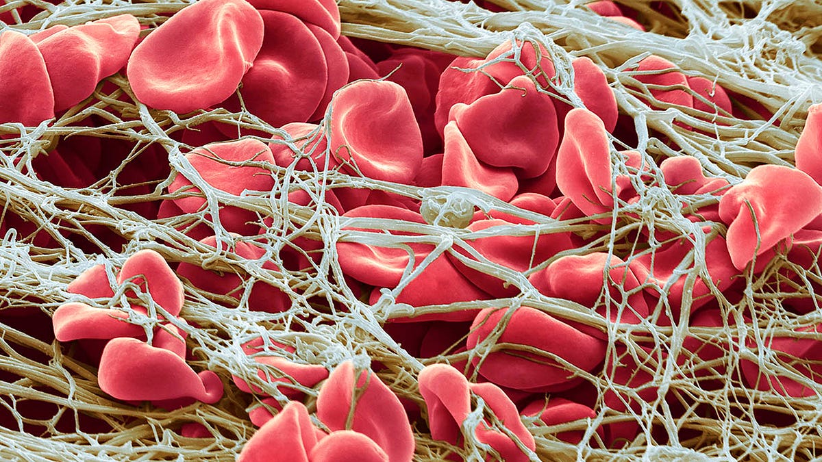 White Fibrous Clots: Embalmers’ Alarming Discoveries and Peer-Reviewed ...