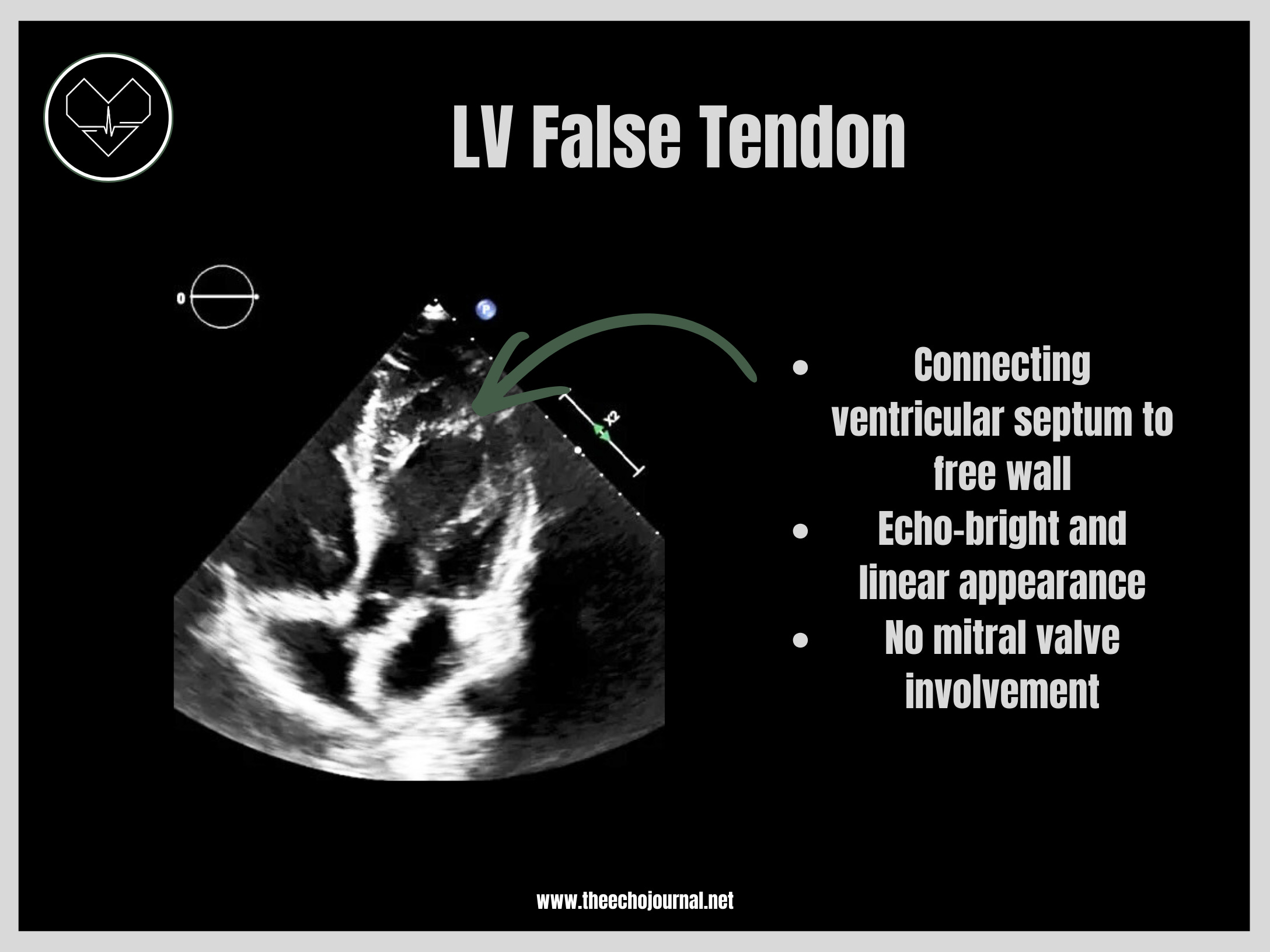 Left Ventricular False Tendon: An Anatomical Variant with Clinical ...