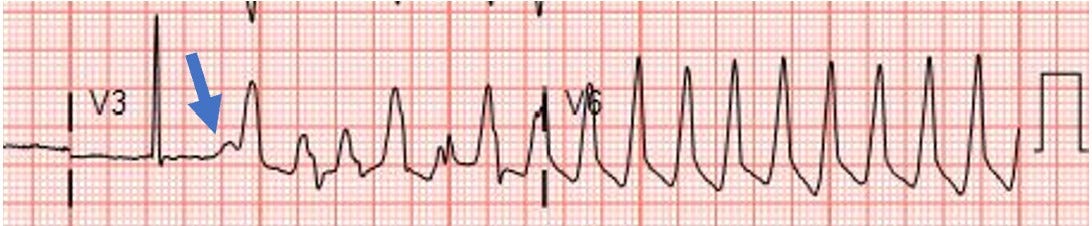 Longer is always better - ECG Teaching Cases