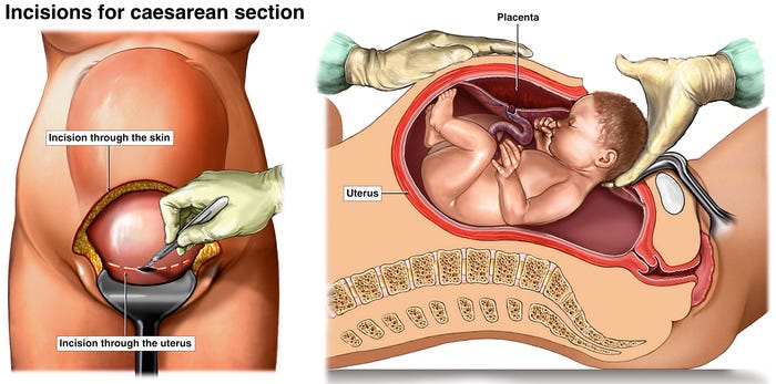 incision after c section