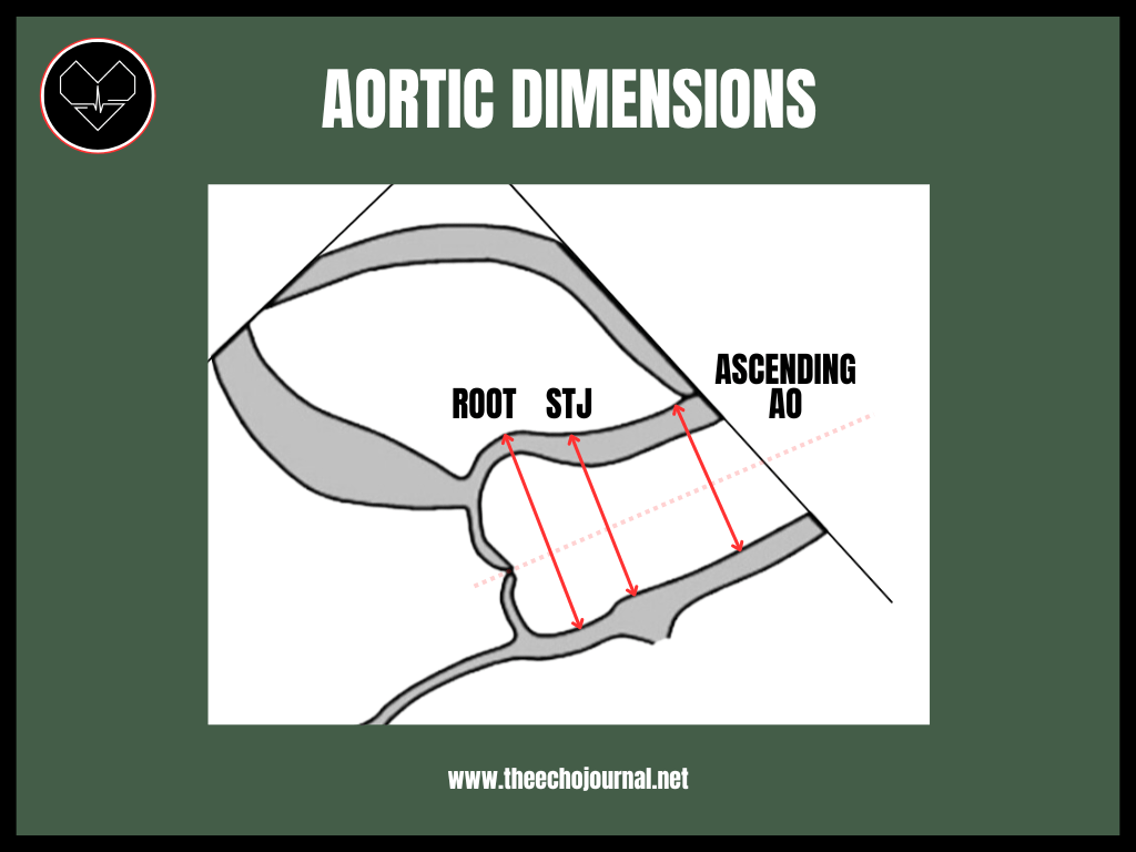 Aortic Root Measurements Ase