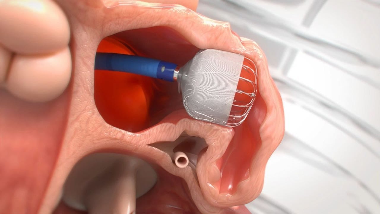 The WATCHMAN™ Device-Left Atrial Appendage Closure (LAAC) Implant