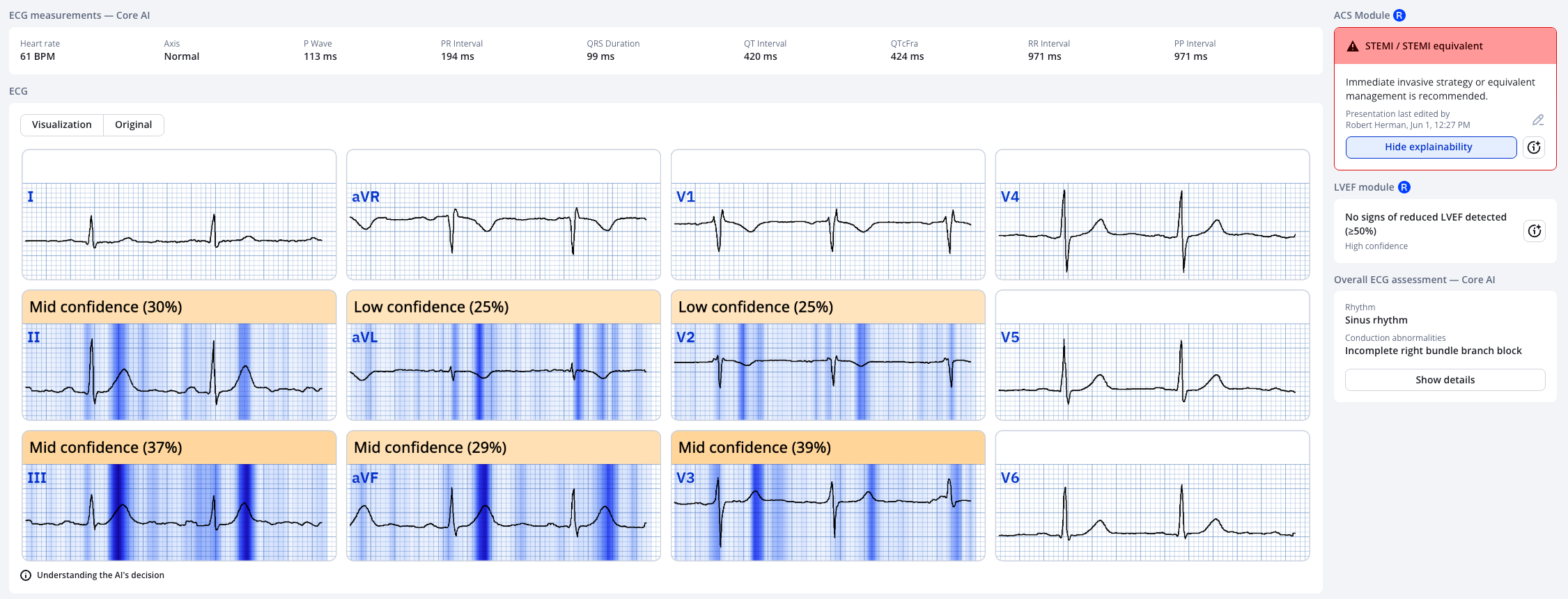Subtle STEMI: The Hidden Threat of Posterior Leads