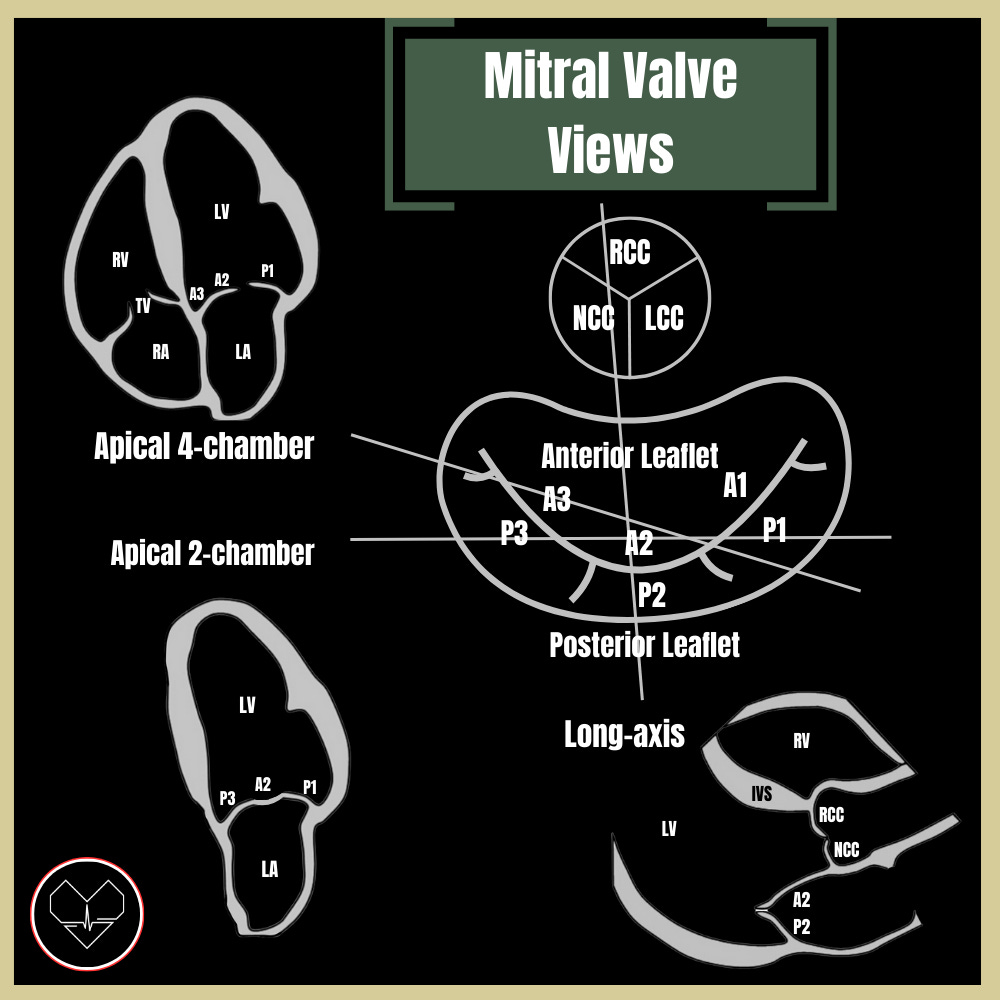 Mitral Valve: Beyond the Basics - by Alex C.