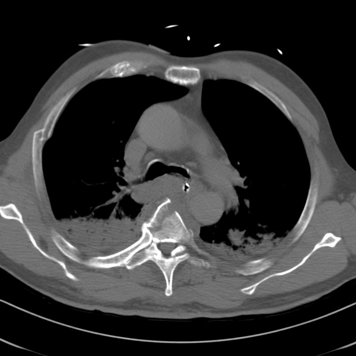 Spinal distraction injuries and dislocation