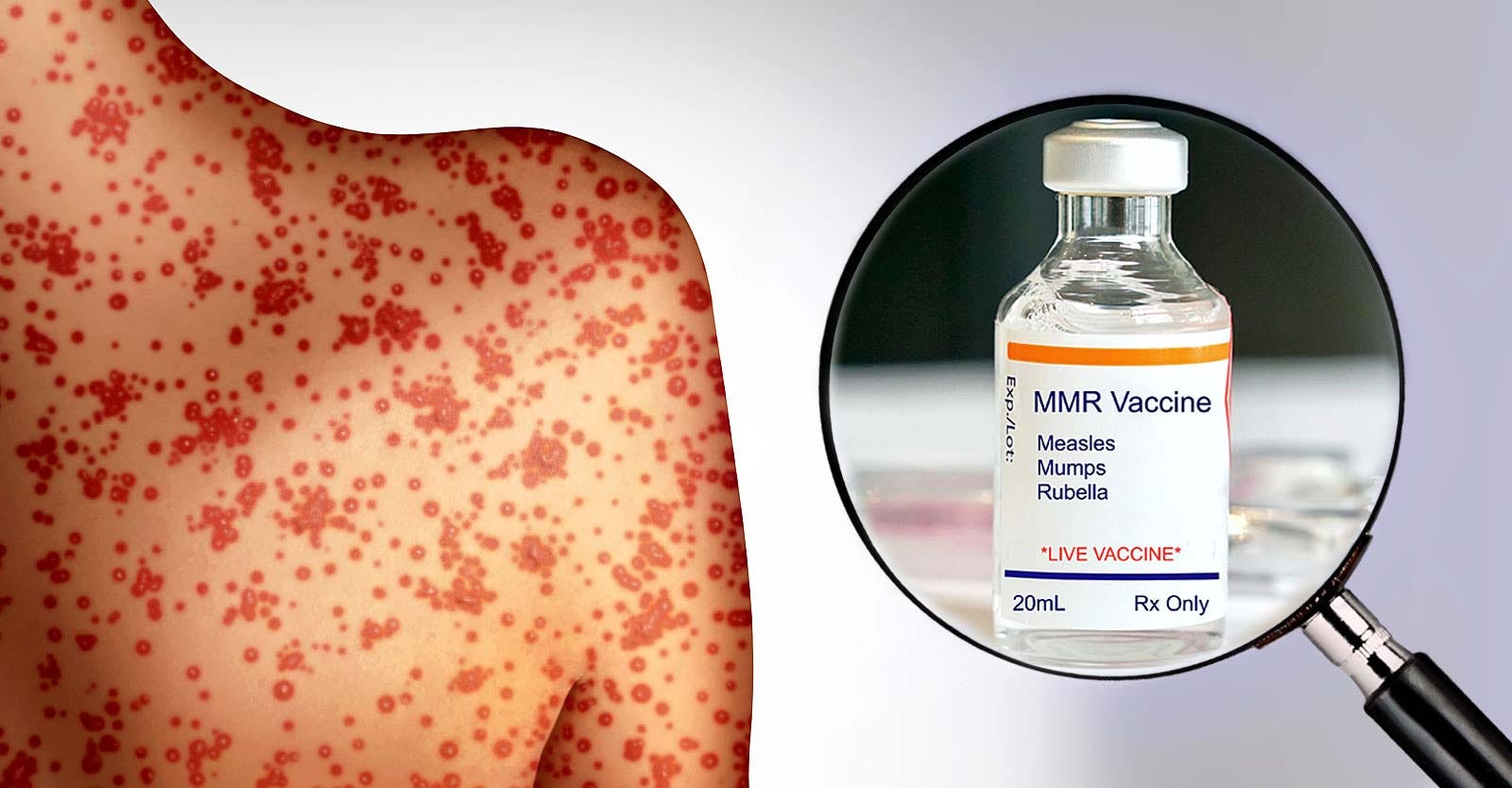 South Carolina Measles Outbreak Spurs Renewed Debate About MMR Vaccine