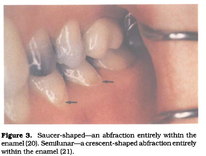 Abfractions: A New Classification of Hard Tissue Lesions of Teeth