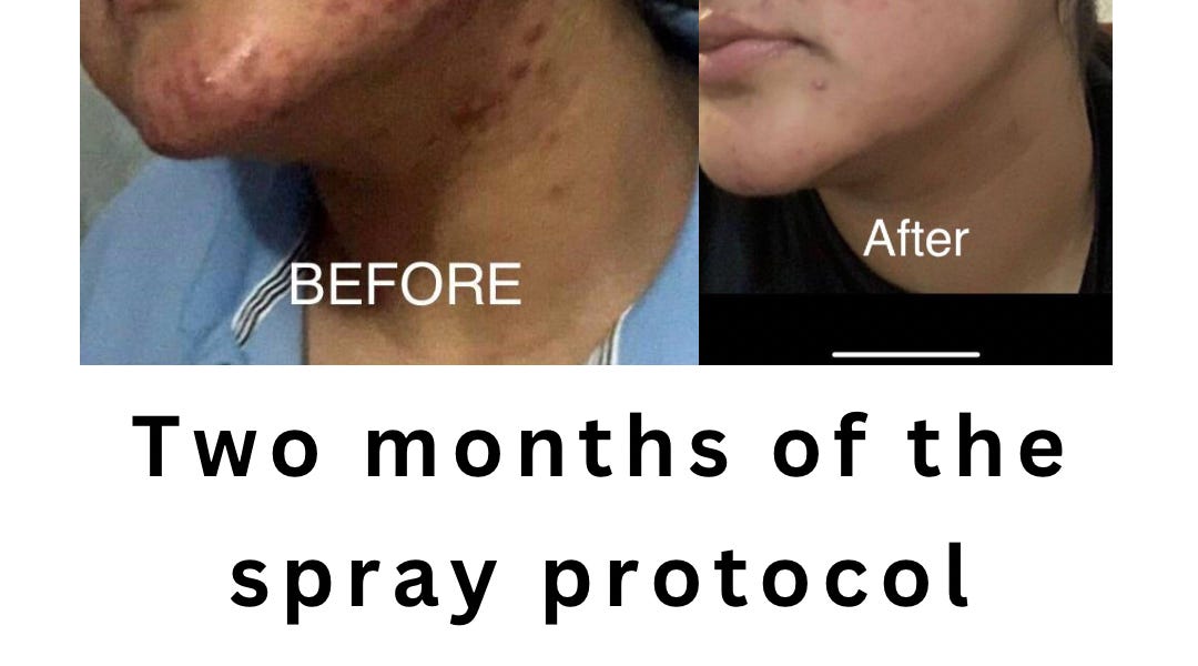 Cure Acne and Eliminate it's Cause With Chlorine Dioxide?