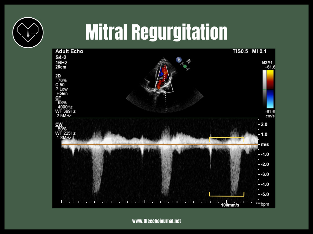 Mitral Annular Disjunction: Findings, Relevance, & Case Breakdown