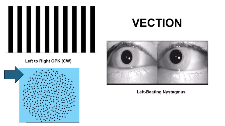 The Saccade Explained: Decoding the Eye Movements You See at the Bedside