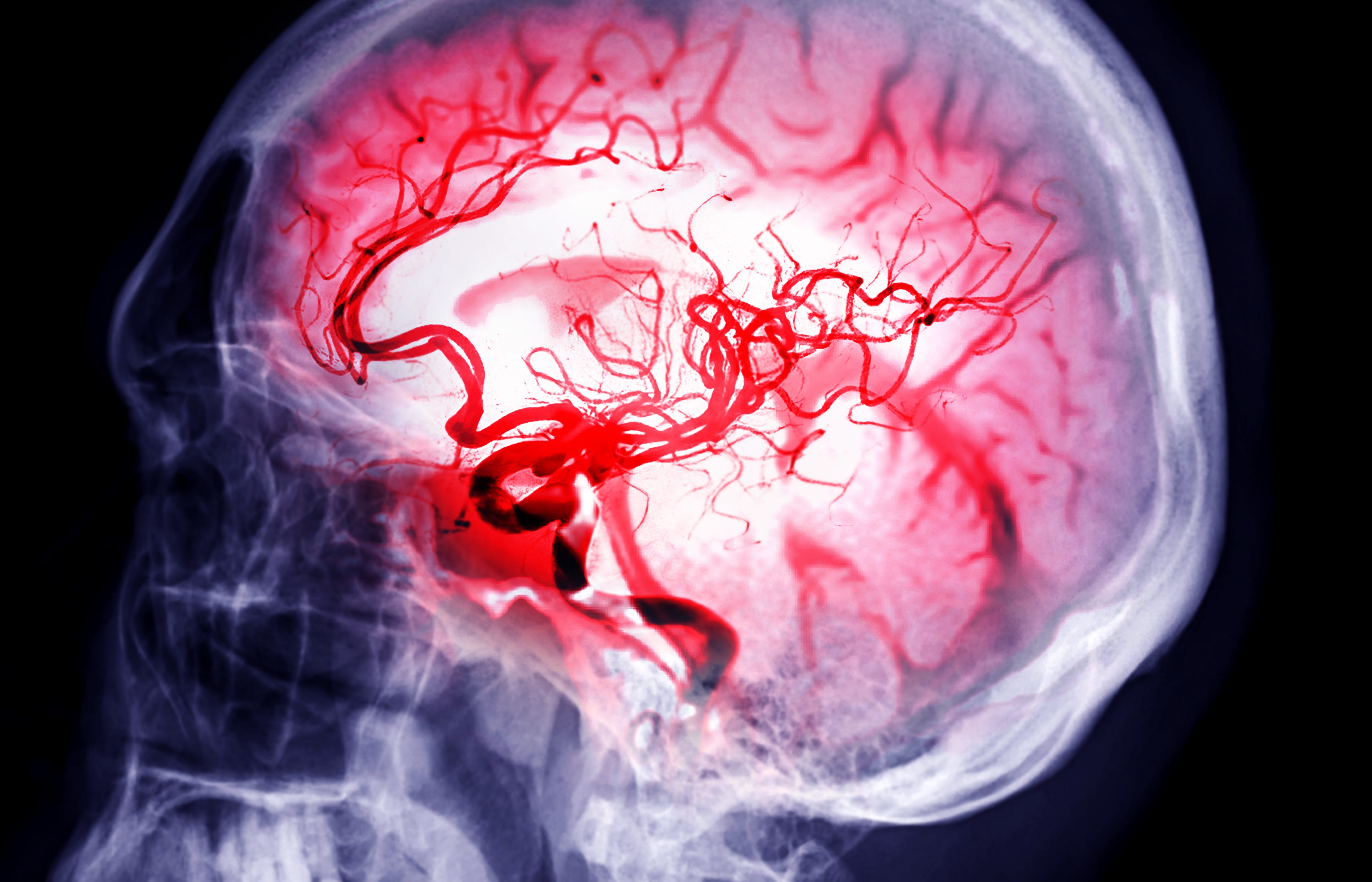 Should thrombolytics be given >4.5 hours after stroke onset?