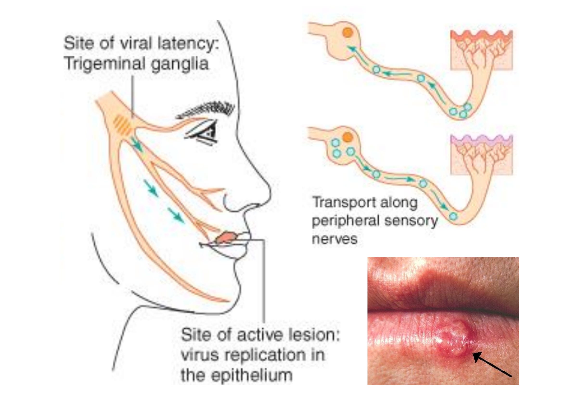 On Subclinical HSV-1 Reactivations, Brain Aging, and Neurodegeneration