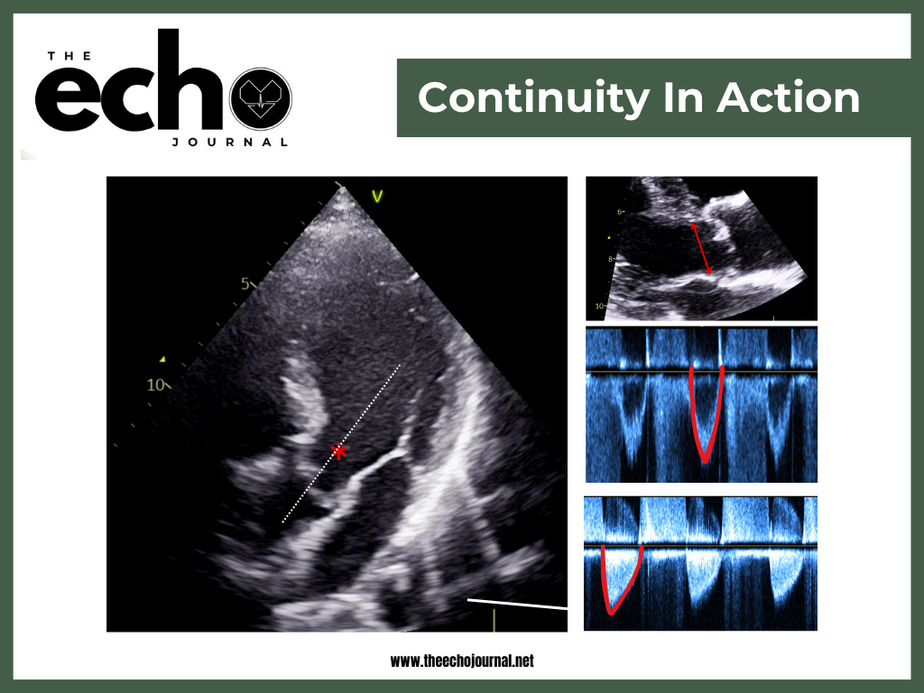 6 Continuity Equation Pitfalls Every Sonographer Should Know