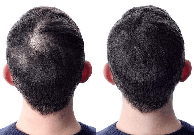 The 10 Best Acupressure Points For Hair Growth - Moosa