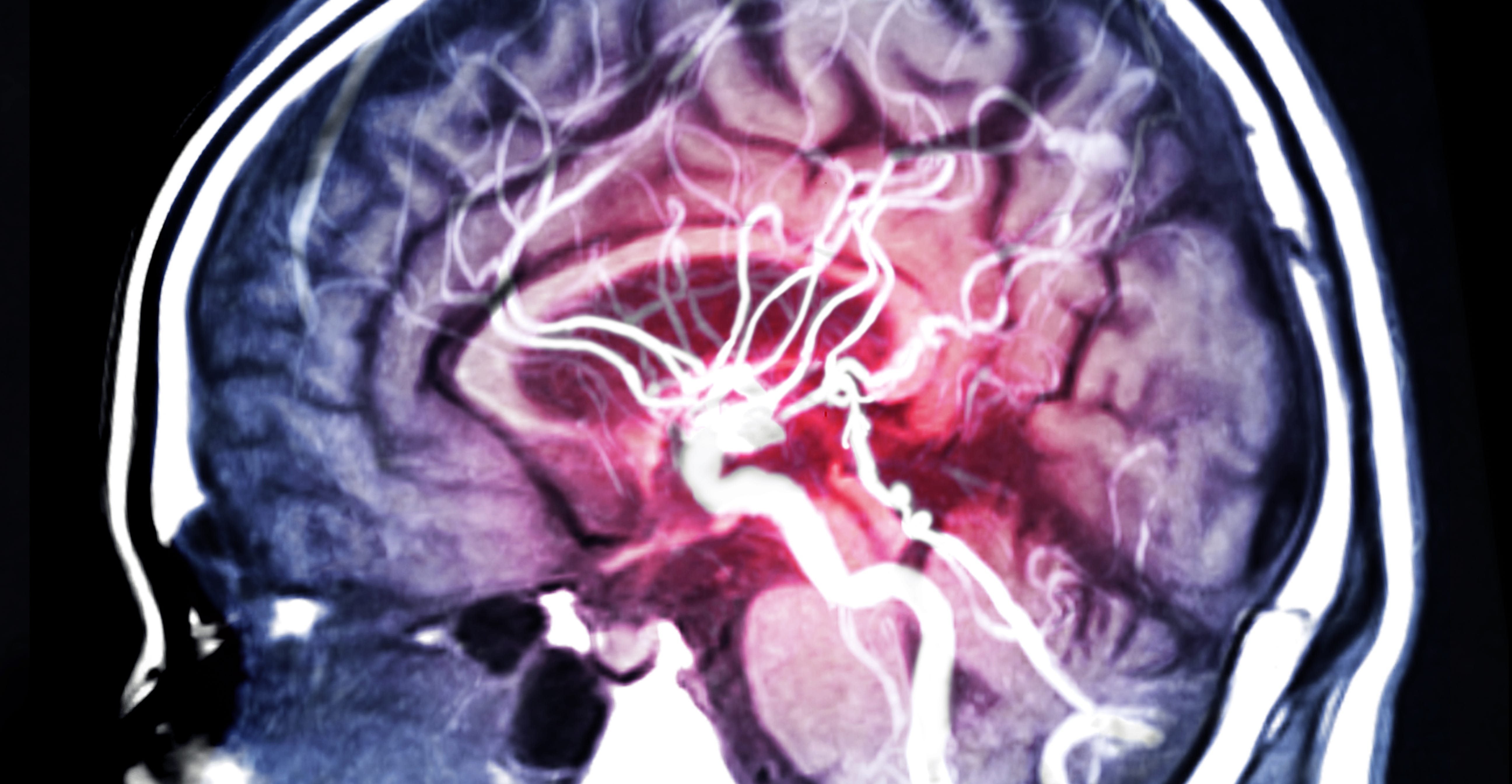 Tenecteplase (TNK) for ischemic stroke after 4 hours