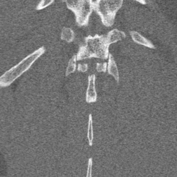 Spinal distraction injuries and dislocation