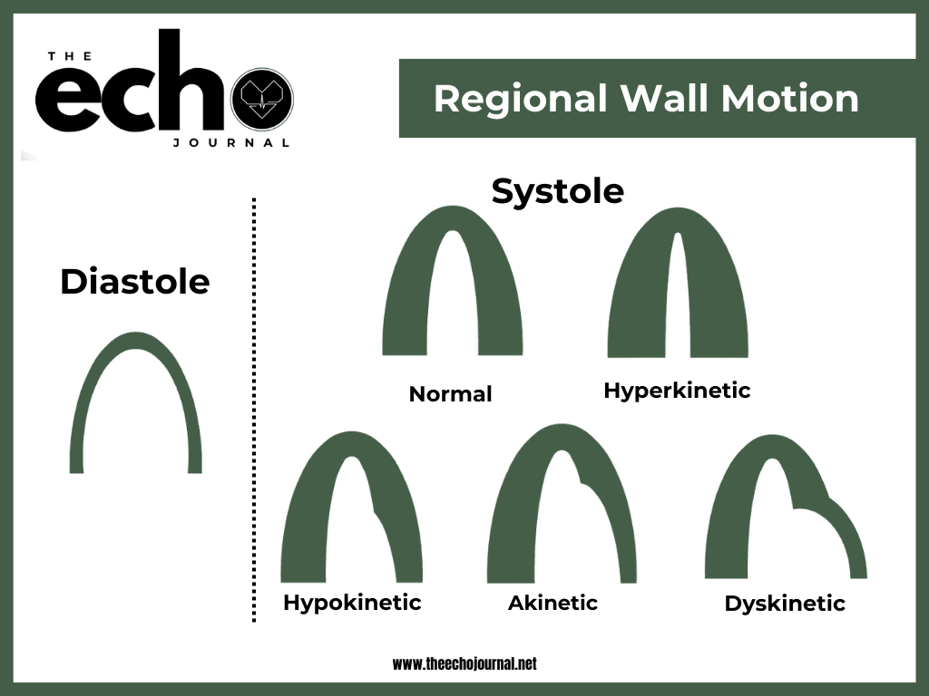 Wall Motion Isn’t Guesswork - by Alex C. - The Echo Journal