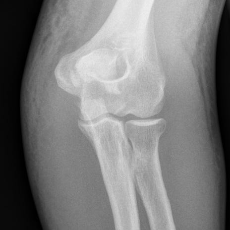 Olecranon fracture and triceps avulsion