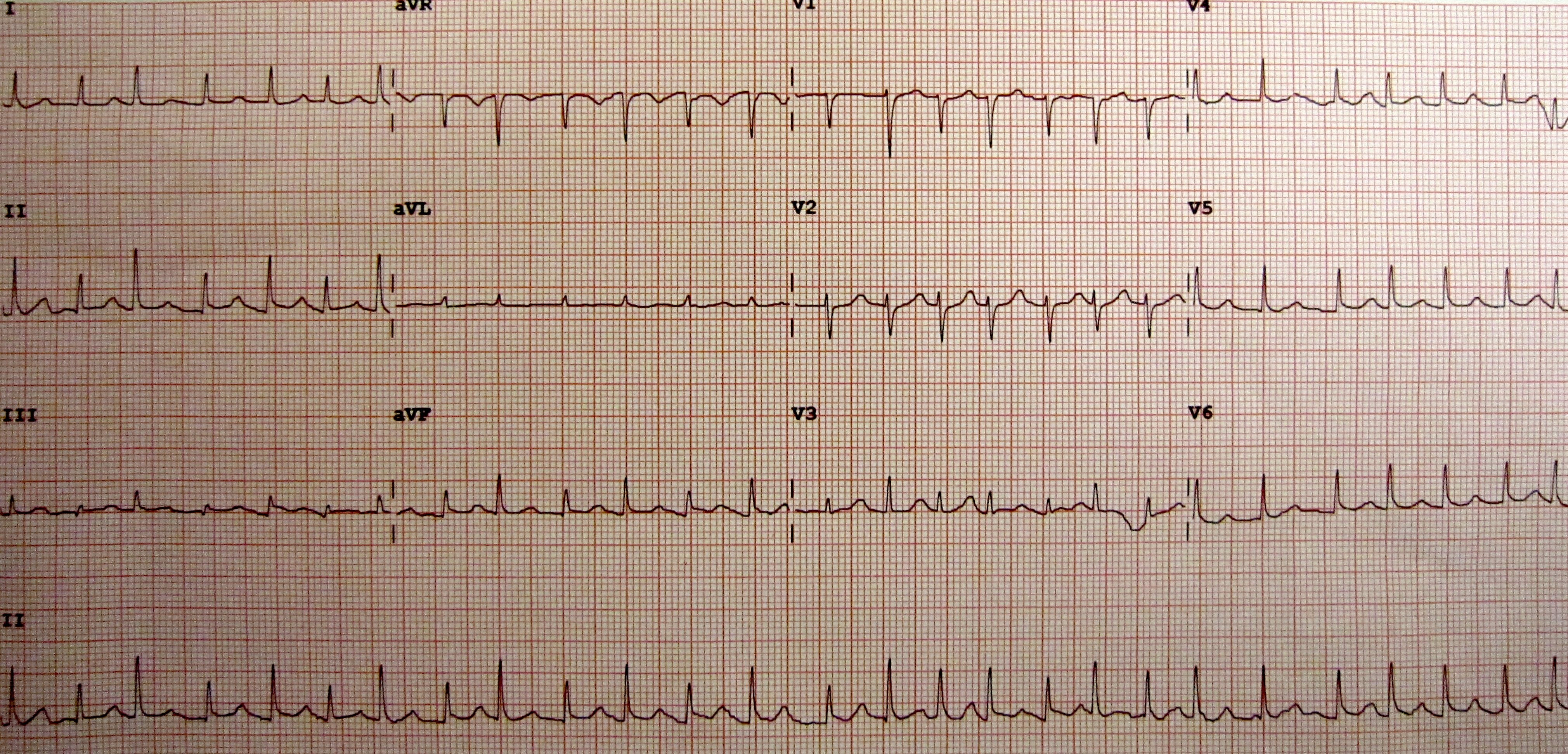 Low QRS voltage (LQRSV) - by Ioannis Protonotarios