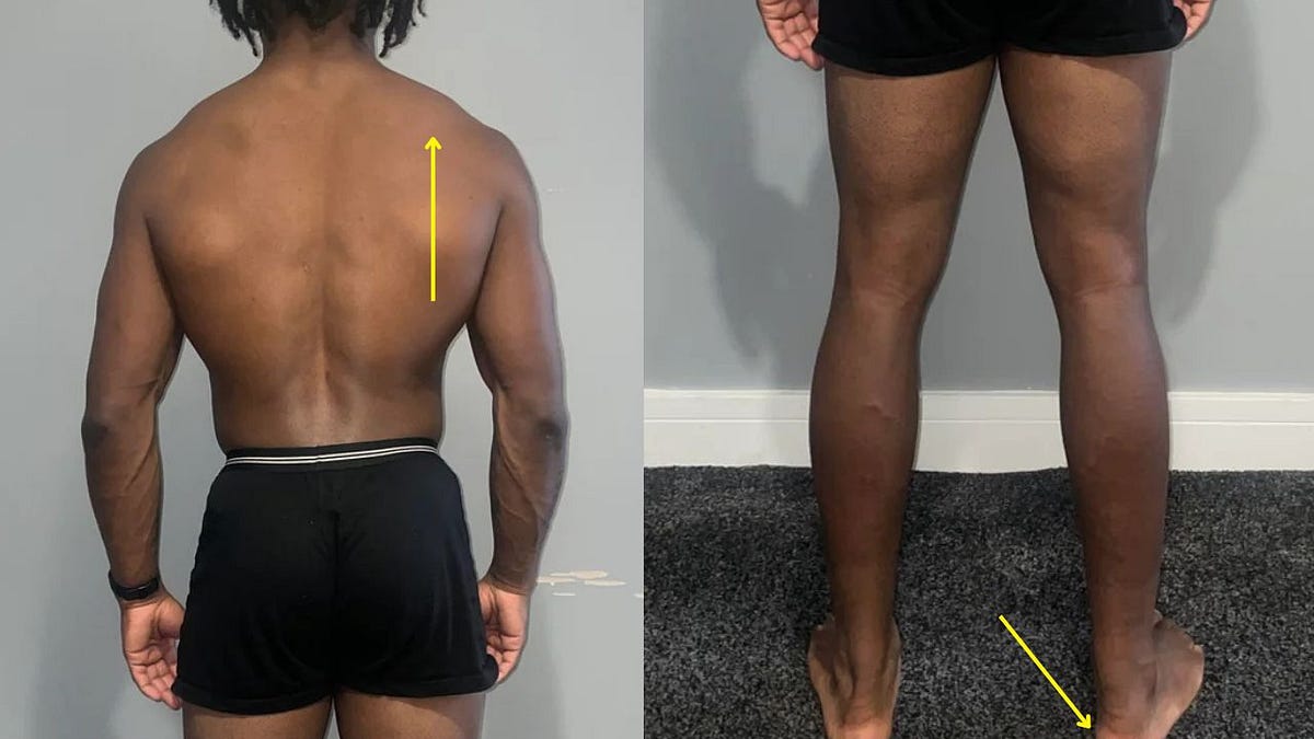 Why One Shoulder Sits Lower Than the Other (And How to Fix It)