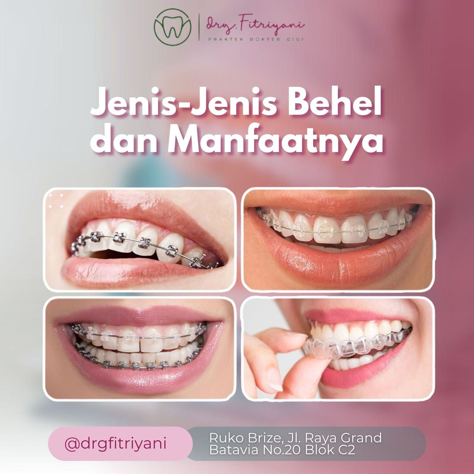 Jenis-Jenis Behel dan Manfaatnya untuk Senyum Sehat