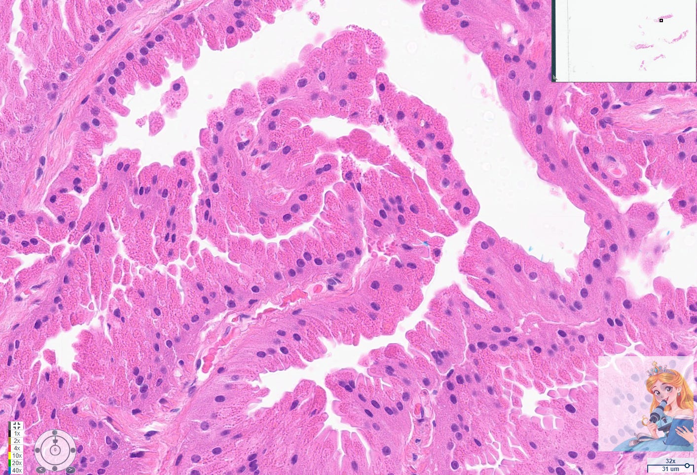 Apocrine Cysts - by Chelsea Mehr, MD - The Path Princess