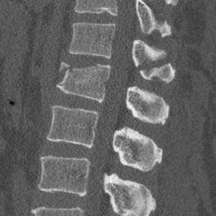 Spinal distraction injuries and dislocation