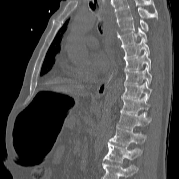Spinal distraction injuries and dislocation