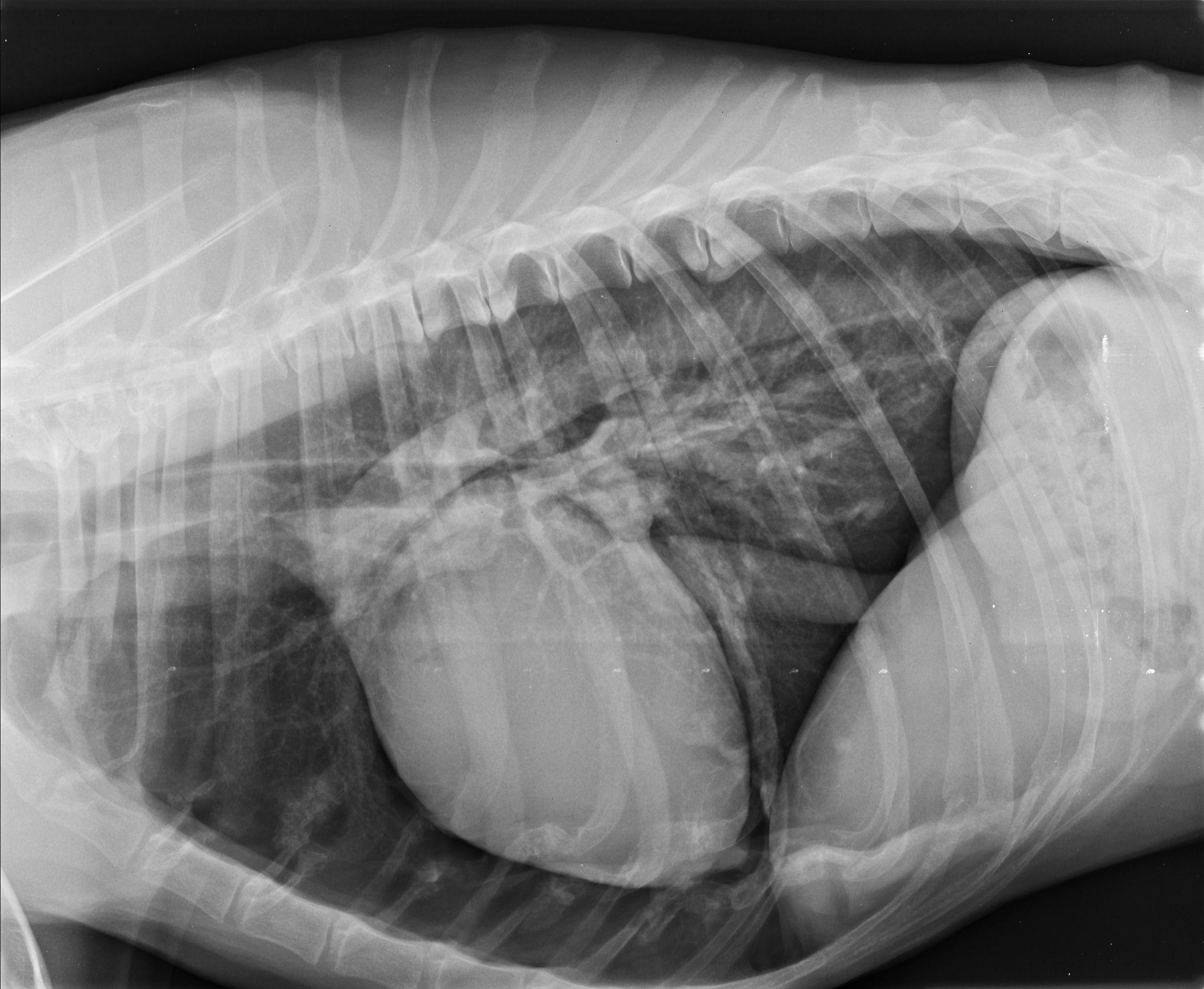 Neumotórax asociado a bullas pulmonares tratado con pleurodesis (II)