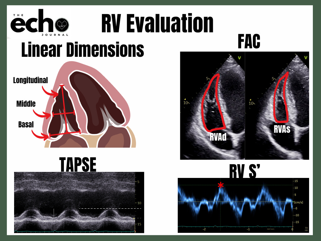 The Displaced Valve: Recognizing Ebstein's Anomaly on Echo