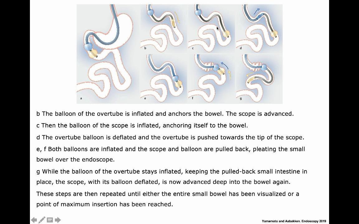 The Small Bowel Black Box is Finally Open: Single vs. Double vs. Spiral ...
