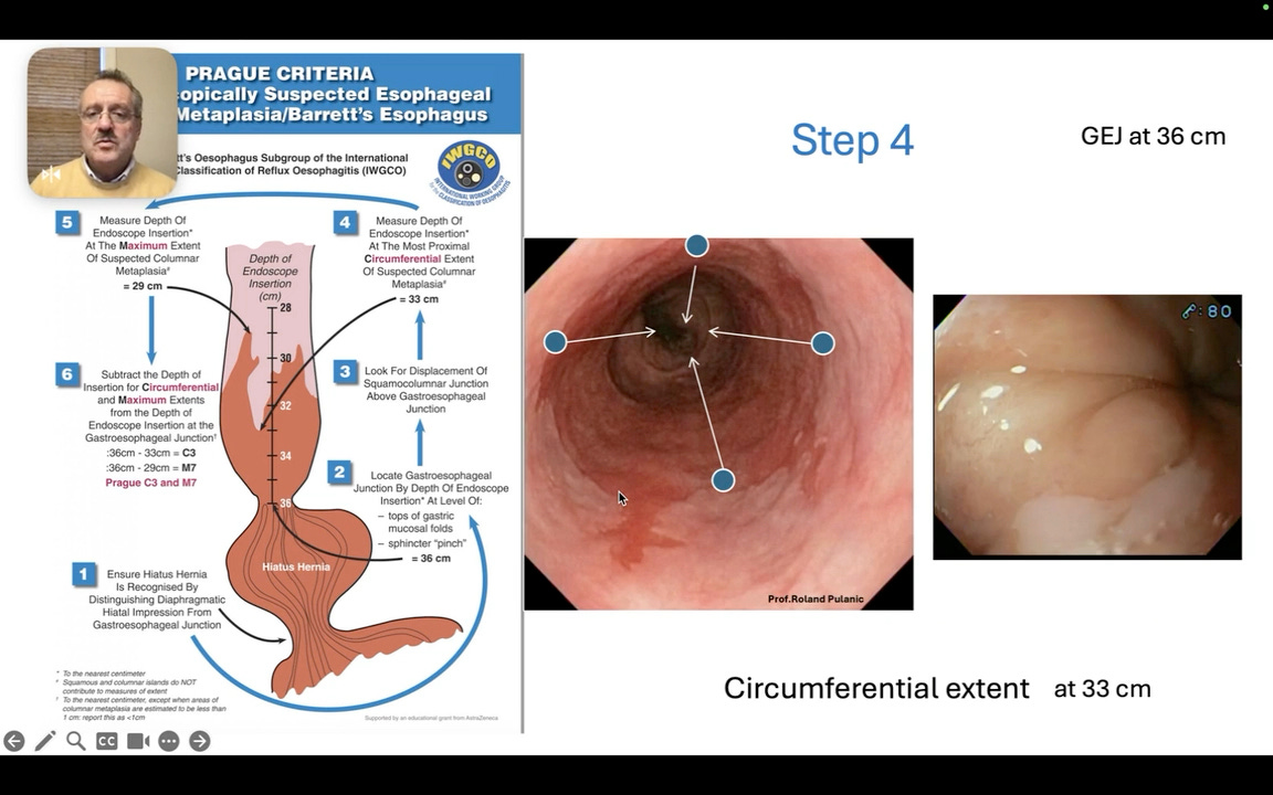 Barrett's Esophagus - Prague Classification - EndoCollab