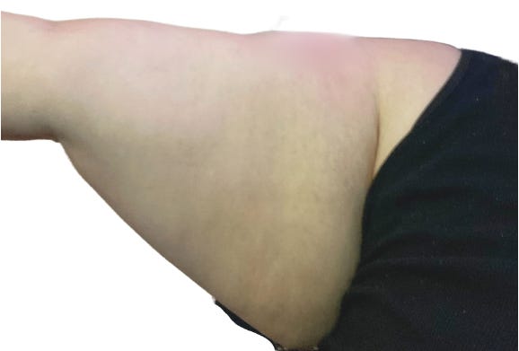 The Need for Troncoconical Blood Pressure Cuffs