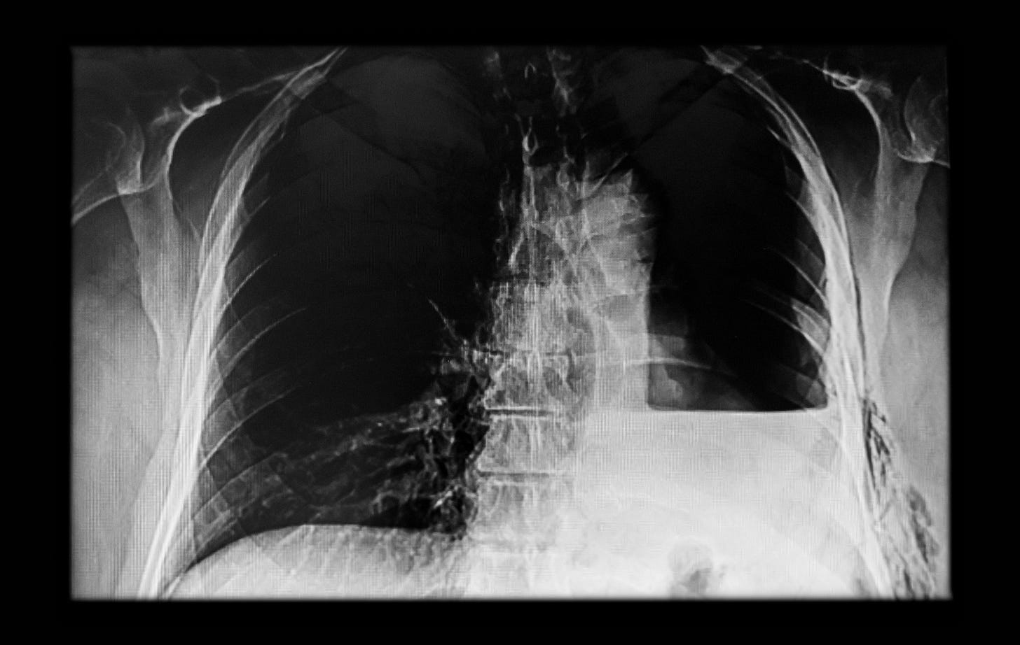 Thoracentesis for pleural effusions from heart failure: does it help?