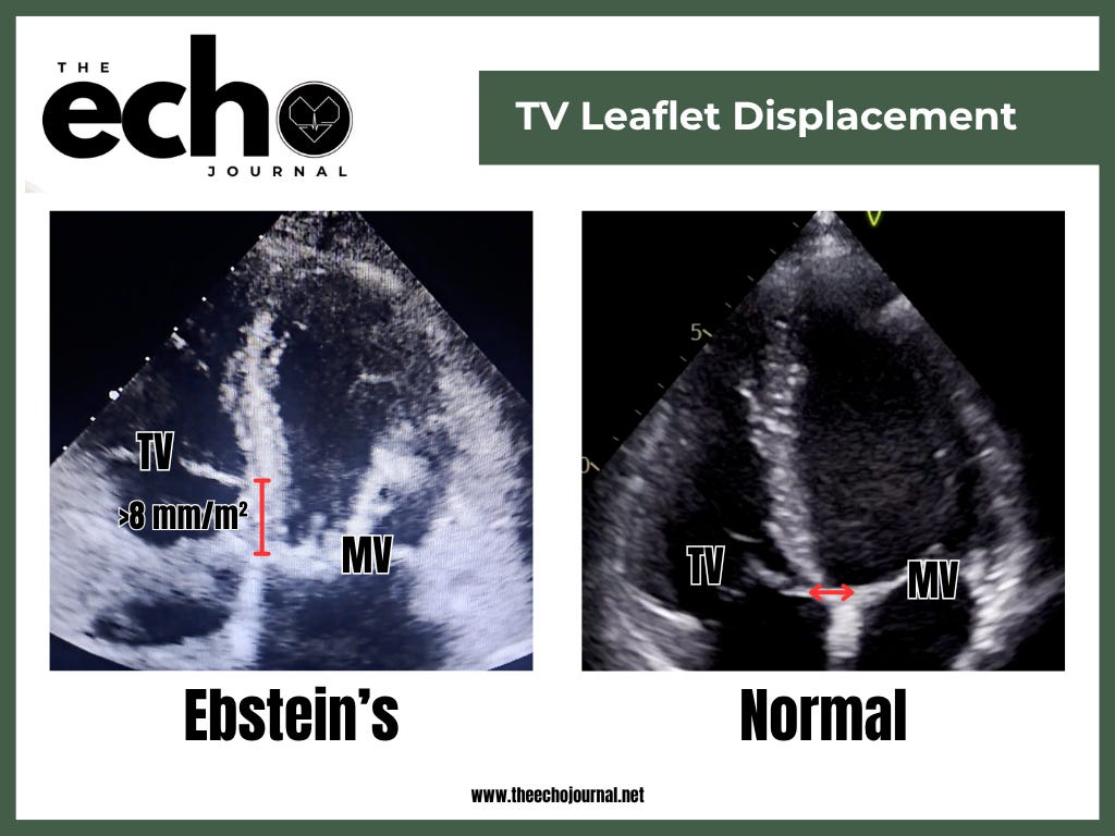 The Displaced Valve: Recognizing Ebstein's Anomaly on Echo